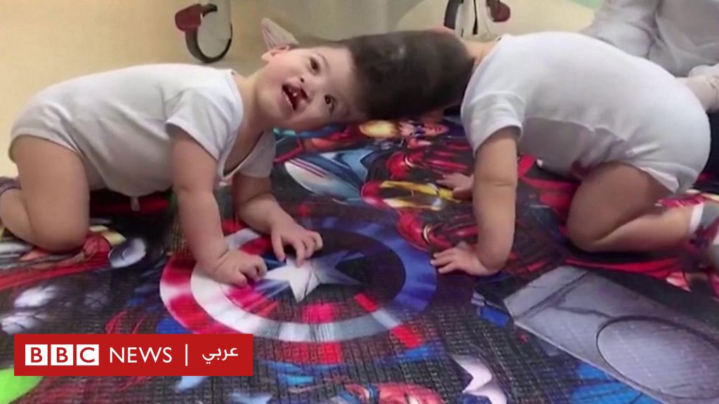 فصل توأم ملتصق عند الرأس بنجاح بمساعدة الواقع الافتراضي إيسايكو